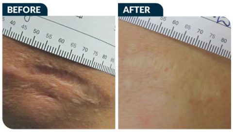 Bi-One® | The Lifetouch - Therapy